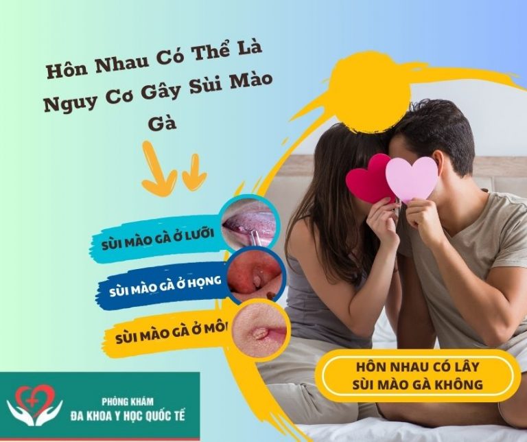 Hôn Nhau Có Lây Sùi Mào Gà Không
